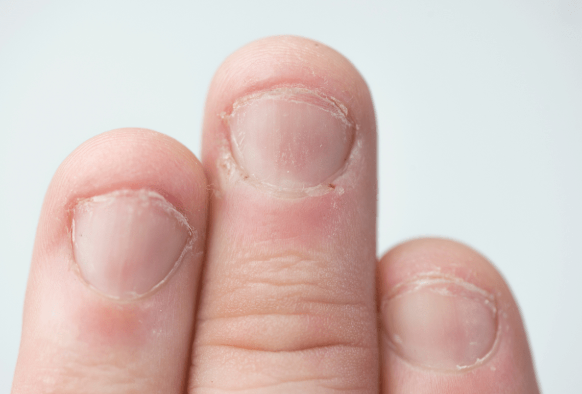 Unhas roídas: Entendendo e superando o hábito com 13 dicas